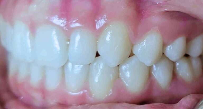 Deep Bite: Before and After