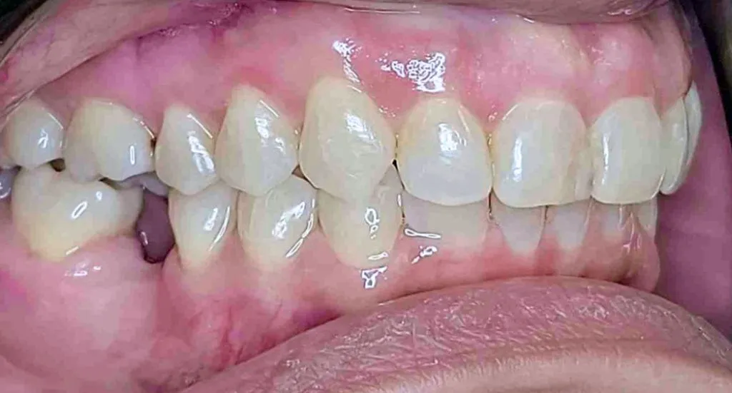 Deep Bite Face Change: Before and After Transformations
