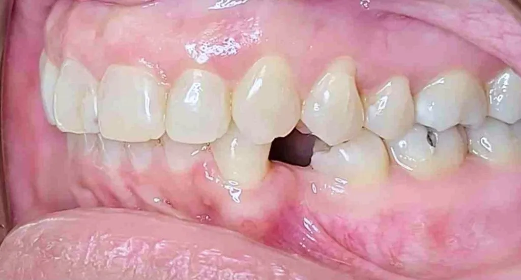Deep Bite Face Change: Before and After Transformations