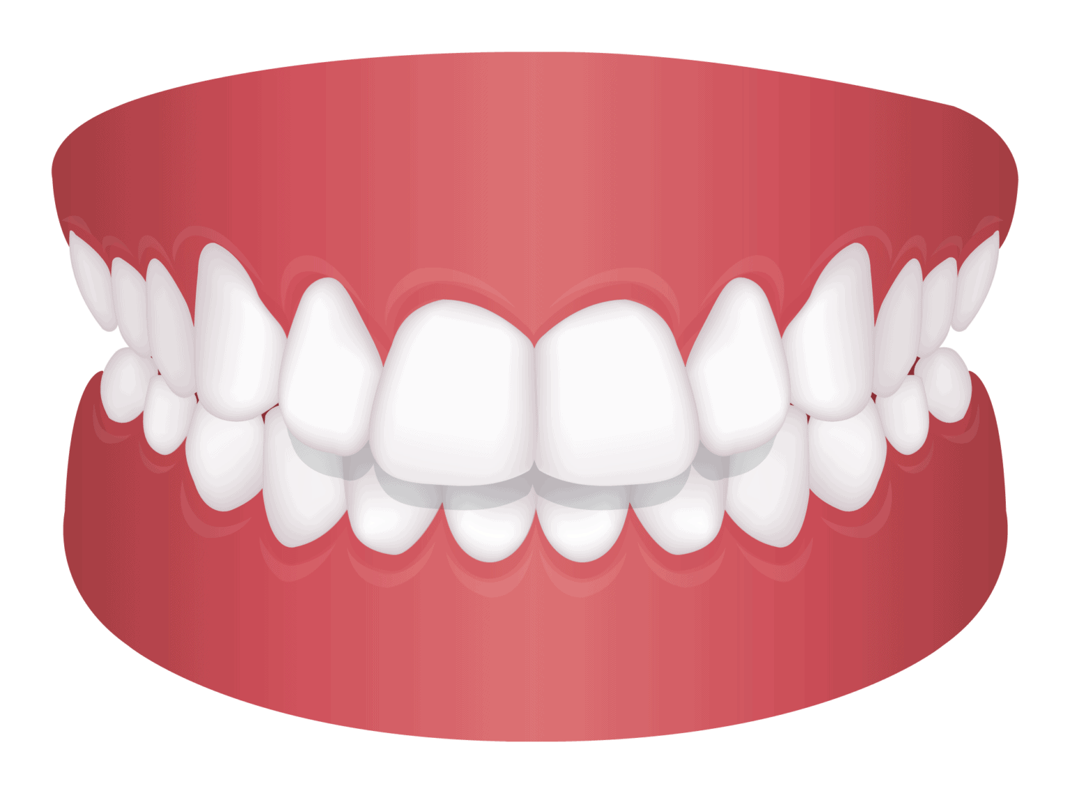 Overjet vs Overbite - The Difference and How To Correct - Beverly Hills ...