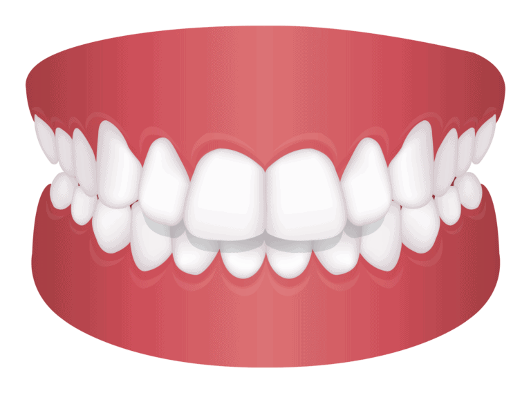 Overjet vs Overbite - The Difference and How To Correct - Beverly Hills ...