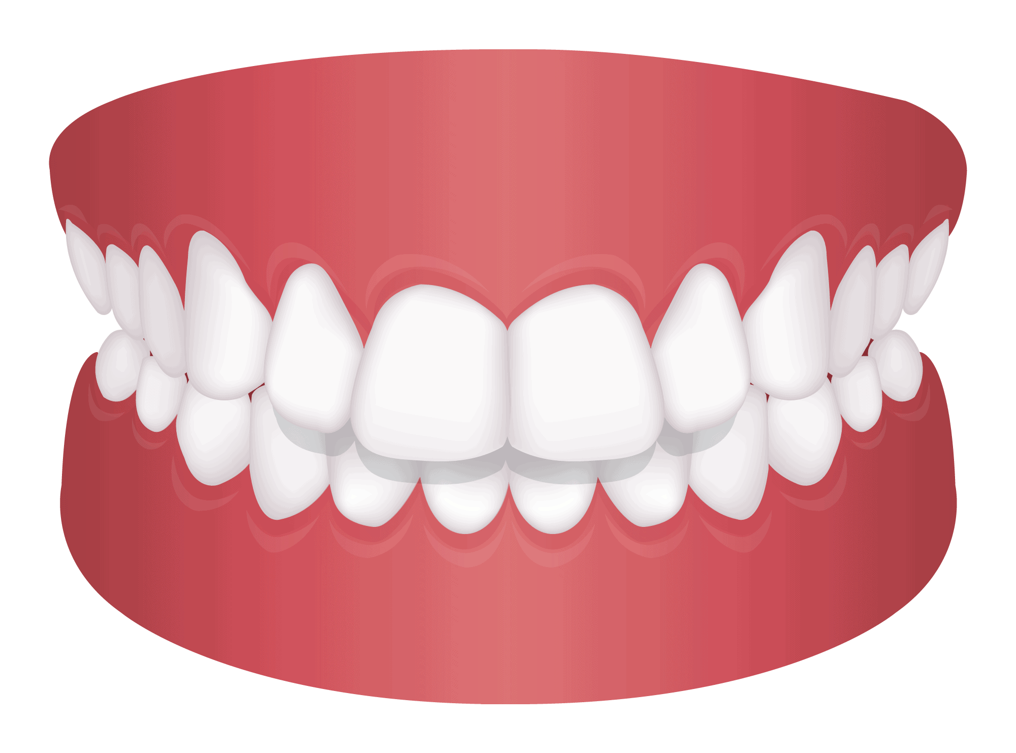 Overjet vs Overbite - The Difference and How To Correct - Beverly Hills ...