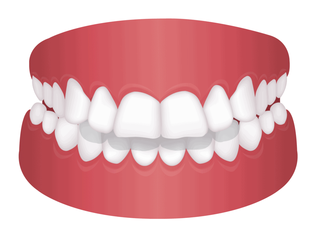 Overjet Vs Overbite The Difference And How To Correct Beverly Hills