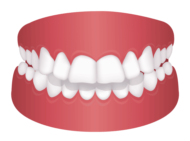 Overjet vs Overbite - The Difference and How To Correct - Beverly Hills ...