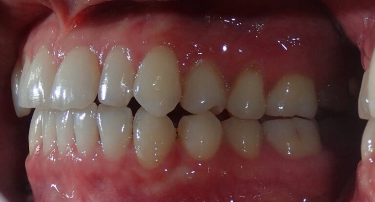 Invisalign: Before and After